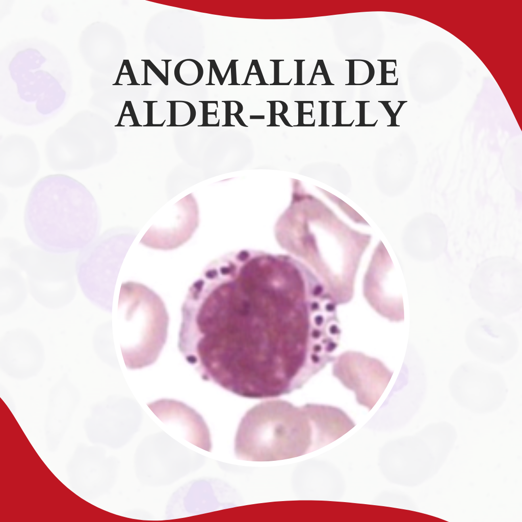 Anomalia de Alder-Reilly: causas, sintomas e tratamento