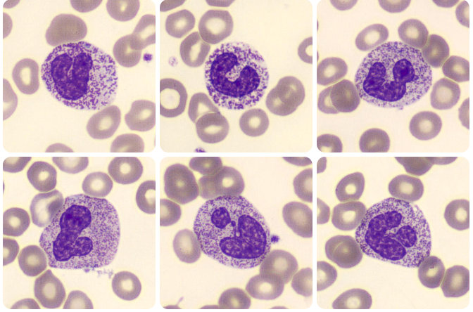 GRANULAÇÕES GROSSEIRAS - Blog - Atlas em Hematologia