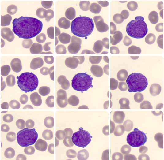 LINFOMA DE BURKITT - Blog - Atlas em Hematologia