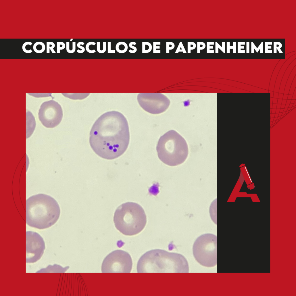 Corpúsculos de Pappenheimer - Blog - Atlas em Hematologia
