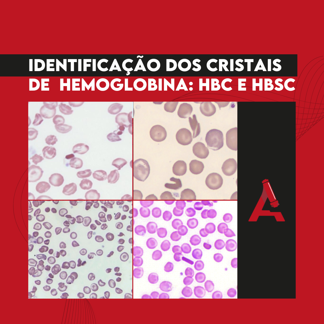 Identificação dos cristais de hemoglobina: HbC e HbSC - Blog - Atlas em ...