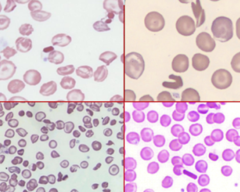 Identificação dos cristais de hemoglobina: HbC e HbSC - Blog - Atlas em ...